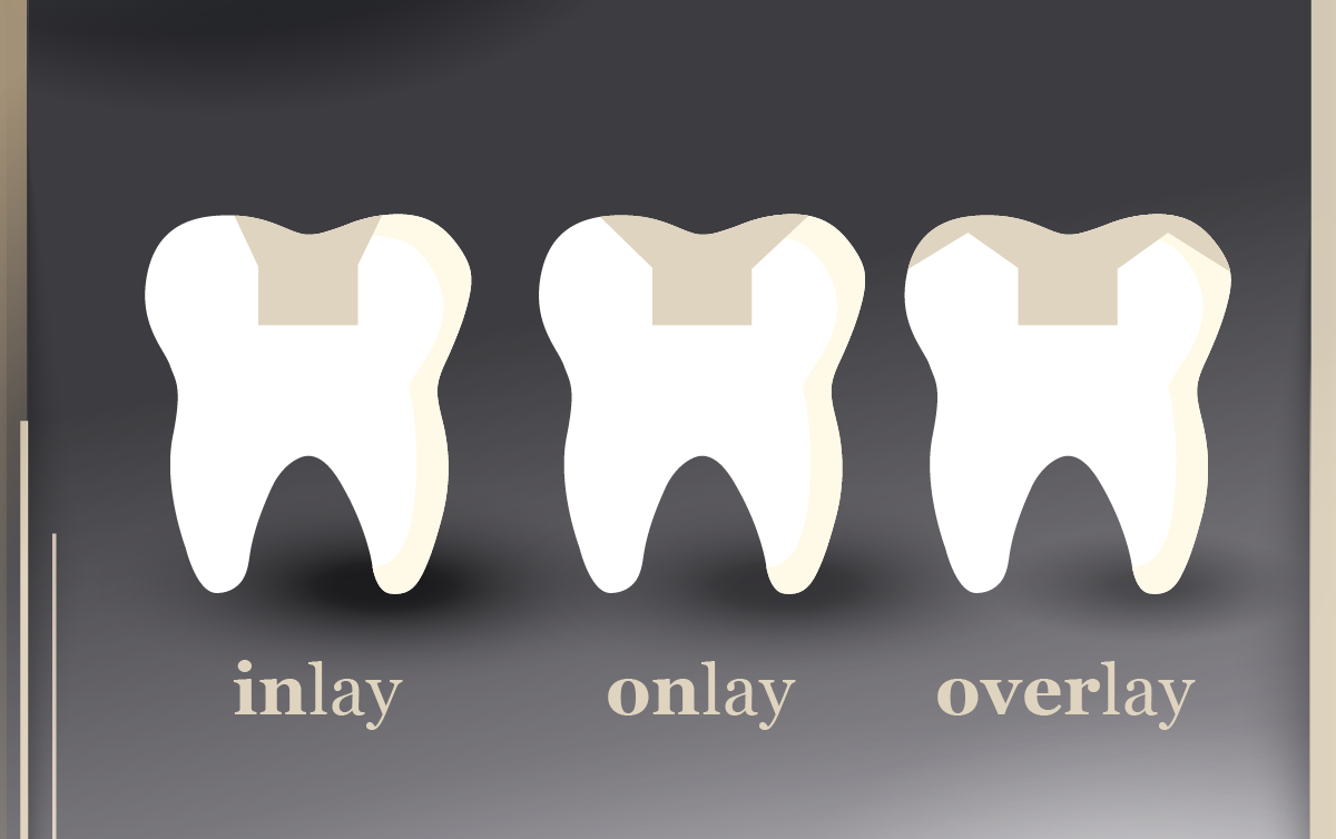 Onlay, inlay, overlay - pomiędzy plombą a koroną